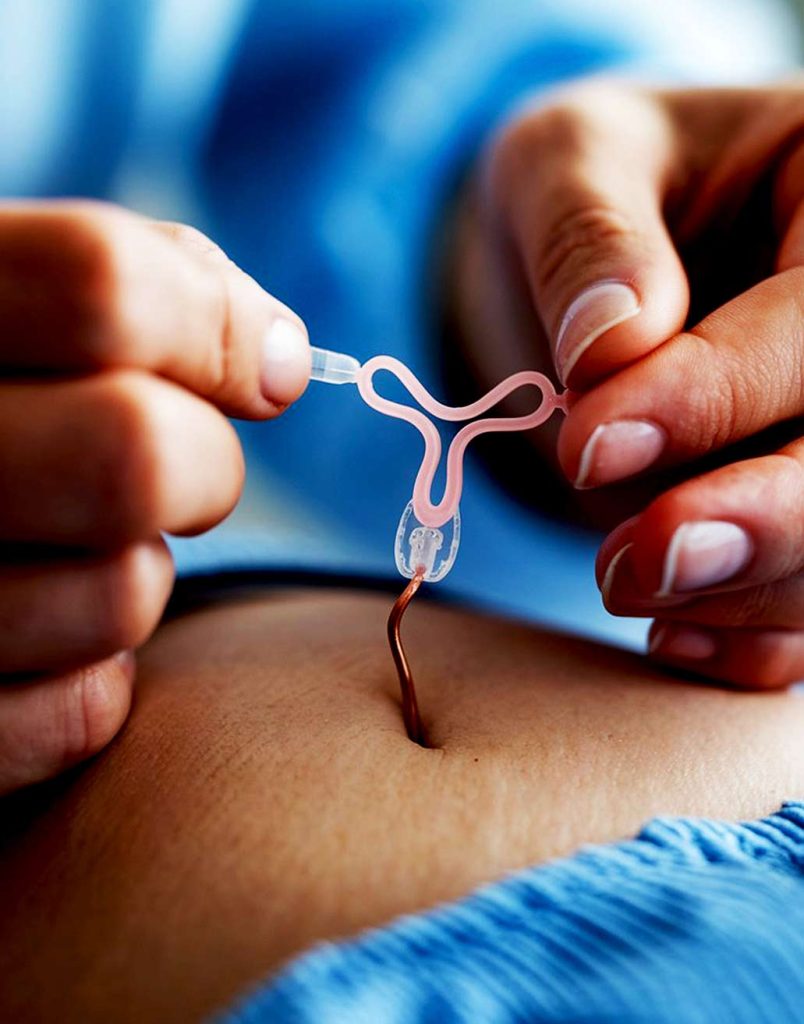 Intrauterine Insemination / Ovulation Induction - Center For ...